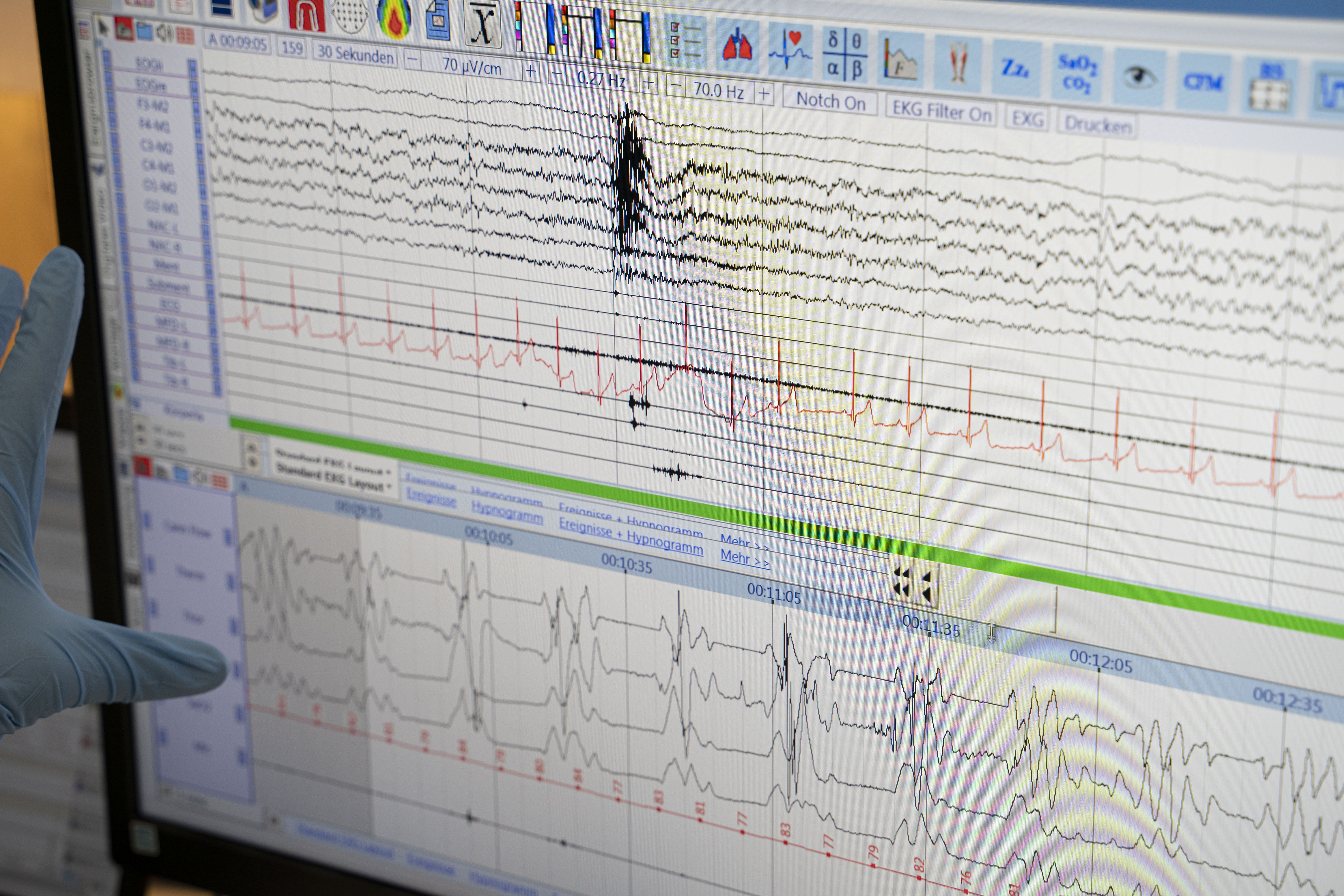 SLAPNEA - Maladaptive consequences of nocturnal periodic breathing at ...